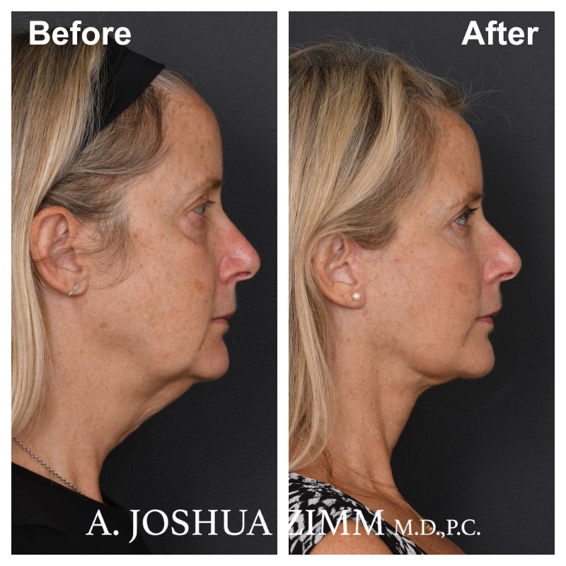 How Much Does a Facelift Cost in NYC? Price Breakdown & What to Expect
